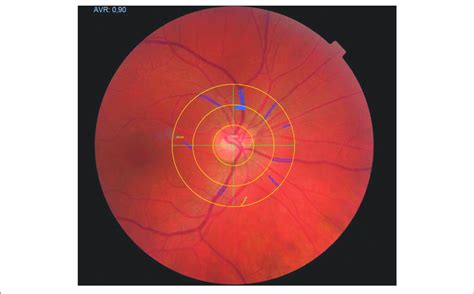 Retina Fundoscopy At Zachary Barber Blog
