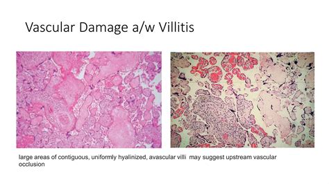 Placenta Pathology Pdf Pregnancy Reproductive Health