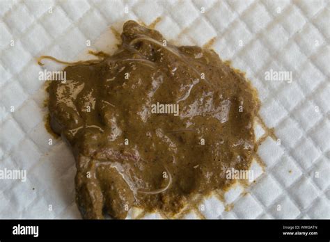 What Do Pinworms Look Like In Poop At Jasper Gunson Blog