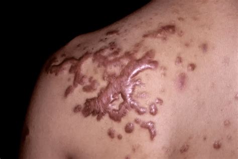 How To Stop A Keloid From Growing Lumine Dermatology And Laser Clinic