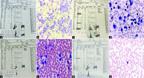 Comparison Of White Blood Cell Detection By Automated Hematology