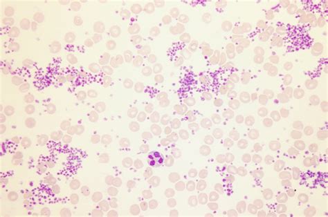 Characterizing Intracranial Hemorrhage Among Patients With Immune Thrombocytopenia Hematology
