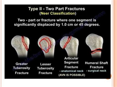 Four Part Proximal Humerus Fracture