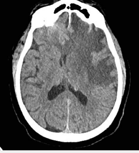 Head Ct Was Done On Presentation Showing Hypo Attenuated Area And Mass Download Scientific
