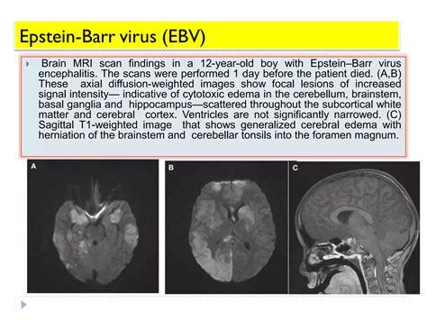 Imaging Of Viral Encephalitis Pptx