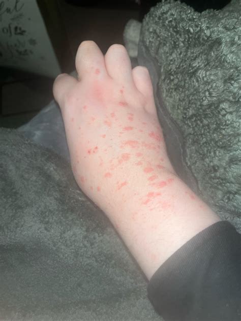 Thought I Was Healing But This Has Got Worse Over The Last Two Days R