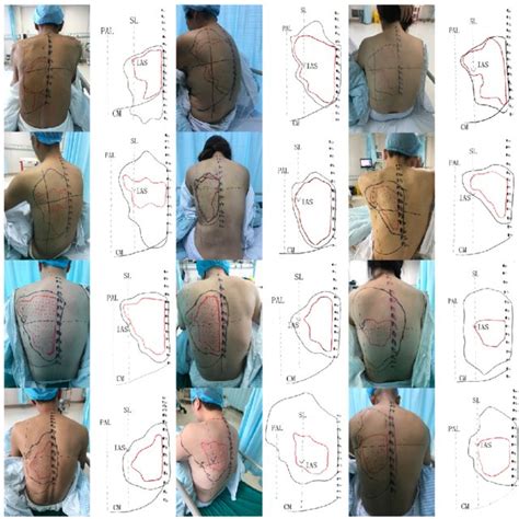 A Positioning And Scanning During Erector Spinae Plane Esp Block