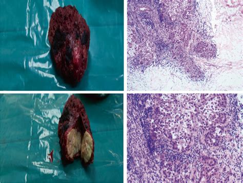 The Macroscopic And Microscopic Views Of The Patients Intrahepatic Lesion Download Scientific