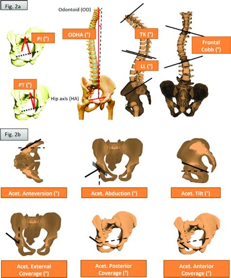 Radiographic Parameters Calculated On 3d Skeletal Reconstructions A Download Scientific