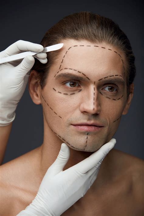 Is Facial Masculinization Permanent