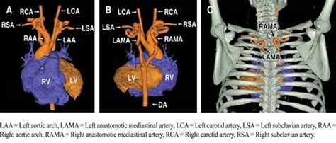A Case Never Reported Before Bilateral Type A Interruption In A Double Aortic Arch Without