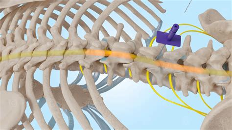 Animation Spinal Cord Stimulator Medicalgraphics