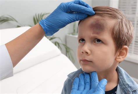 کبودی بدن 9 دلیل اصلی کبودی بی دلیل و درمان عکس بیچشک