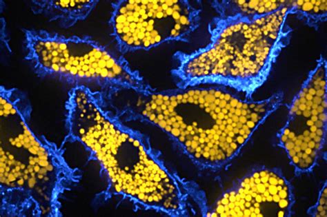 Qanda Researchers Discuss Cellular Inflammation Uncovered In Rare