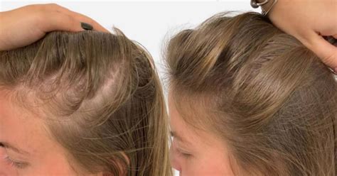 Hair Implants The Solution For Genetic Baldness