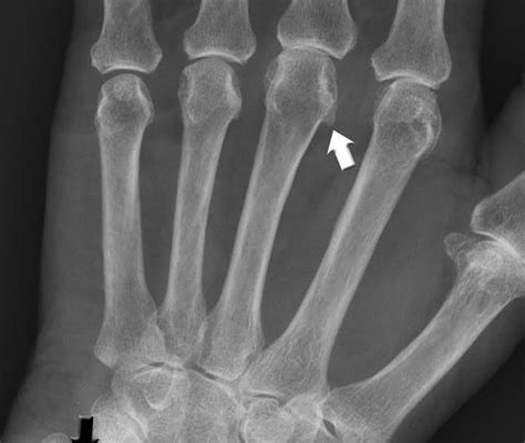 Roentgen Ray Reader Hook Like Osteophytes
