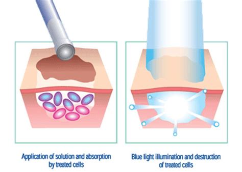 Blue Light Photodynamic Therapy Dermatology Shelly Lighting