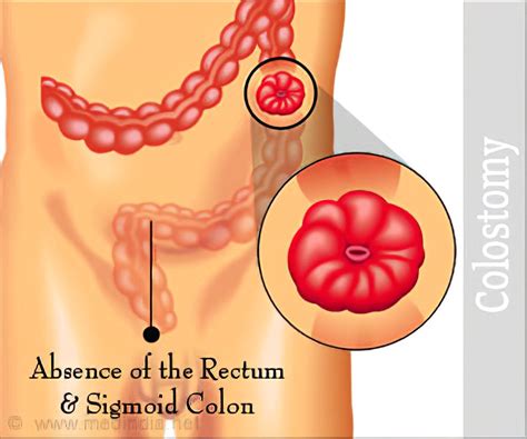 Sigmoid Colostomy