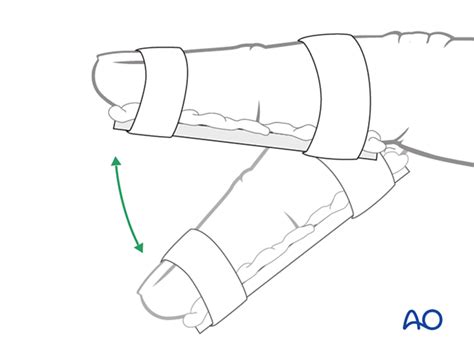 Joint Transfixation With K Wire For Dislocation Of The Distal Interphalangeal Joint