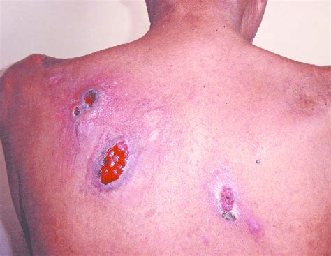 Ulcers With Granulation Tissue And Undermined Borders On The Chest