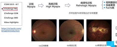 43 图像分类resnet实战：眼疾识别 阿里云开发者社区