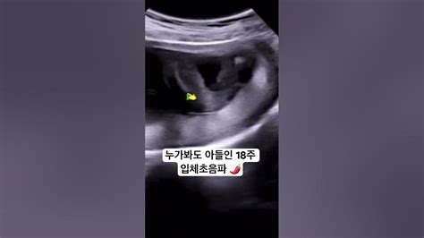 쩍벌 아들 18주 초음파 남자아기 초음파 Youtube