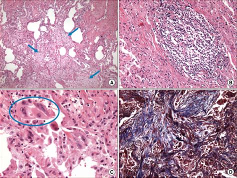 A The Wedge Resected Lung Shows A Temporally Uniform Pneumonic