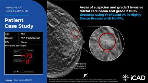 Profound Detection Version 40 The Next Generation In Early Breast