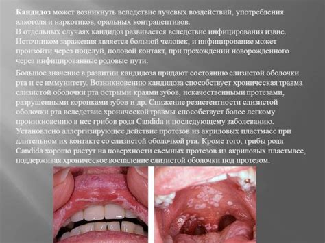 Презентация Кандидоз Привет Студент