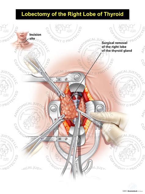 Male Left Lobectomy Vs Total Thyroidectomy