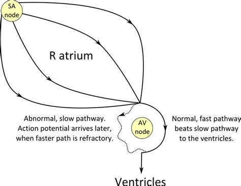 How Do You Know If You Have A Dual Av Node Pathway Raskcardiology