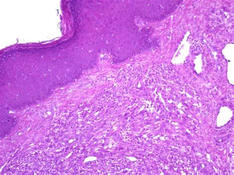 Diffuse Infiltrate Of Polygonal Cells Magnification At ×100