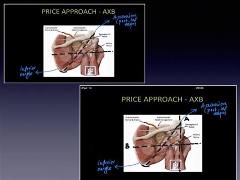 Shoulder Block Tutorial 2014 Ppt