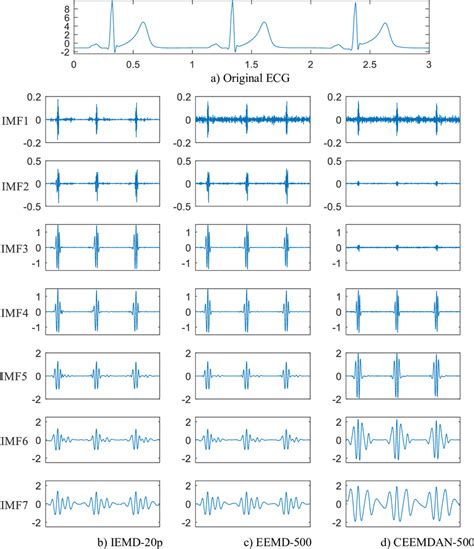 Comparison Of Qrs Detail Waveforms Denoised By Three Denoising Methods Download Scientific