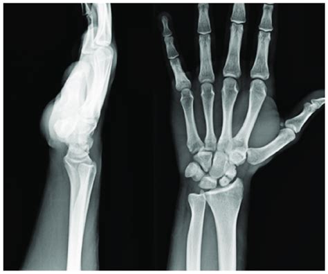 Preoperative Radiographic Imaging Of A Non Union Case Of The Scaphoid Download Scientific