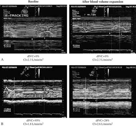 A Inferior Vena Cava Ivc Poor Distensibility Divc Low Predicts No