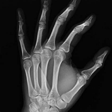 Preoperative Radiograph Of The Left Fourth Distal Phalanx Indicating A Download Scientific