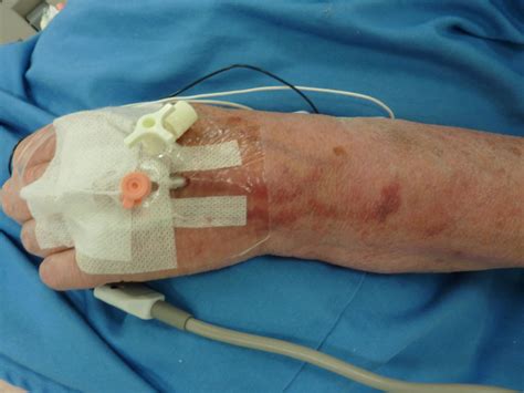Iv Phlebitis