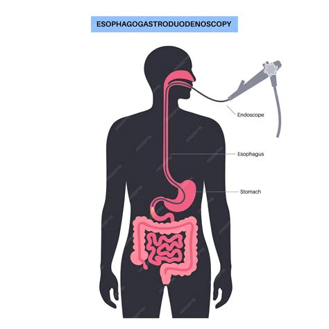 Endoscopy Of The Esophagus Stomach And Duodenum At Keith Maxey Blog