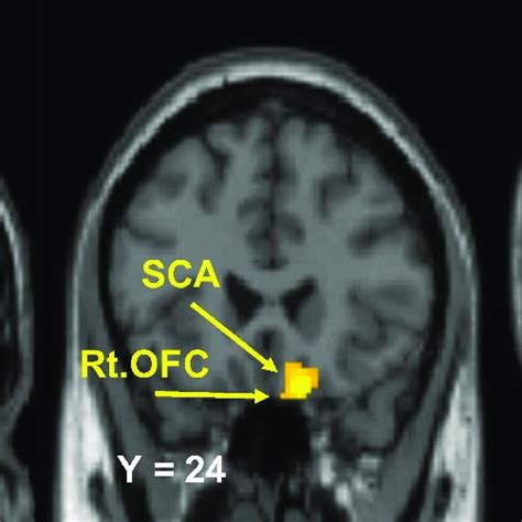 Brain Regions Showing Increased Functional Connectivity With The Left