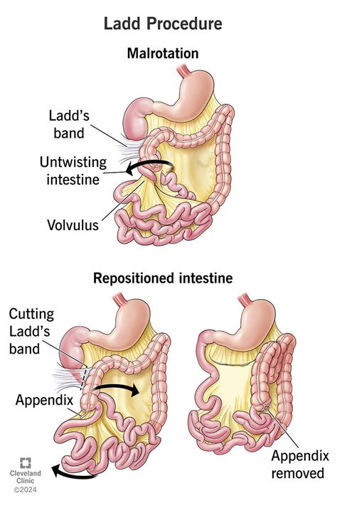 Ladds Procedure Rhabdomyosarcoma Current Therapy Challenges And