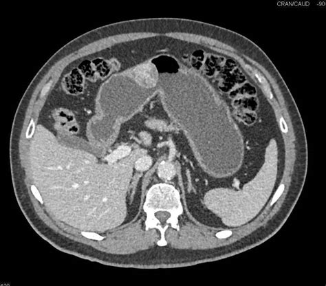 Intraluminal Gastric Gist Tumor Stomach Case Studies Ctisus Ct Scanning