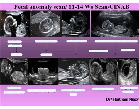 Fetal Anomalies Quiz