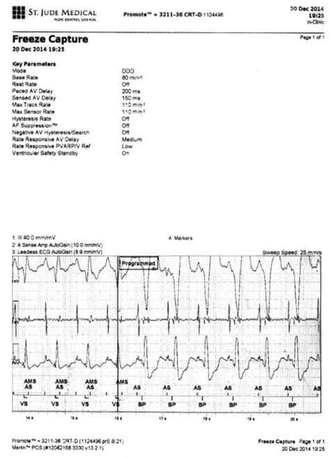 Automatic Mode Switch Ams Causes Less Synchronization Pmc