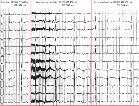 QT Interval Stretching In A LQT Patient A Year Old Woman With Long Download Scientific
