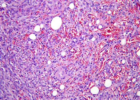 Pathology Outlines Kaposi Sarcoma
