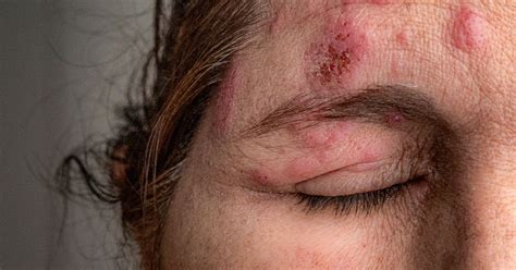 Shingles Symptoms Eye