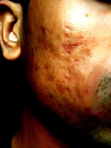 A Serious Question Acne Scar Life Sex Masturbation Acne Scars Acne Org Forum