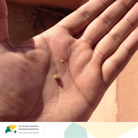 БӨӨРНИЙ ЧУЛУУ ГЭЖ ЮУ ВЭ Бөөрний Ub Songdo Hospital Facebook