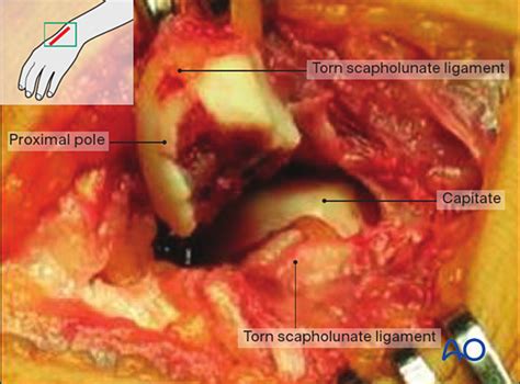 Orif Through Dorsal Approach Antegrade Screw Fixation For Scaphoid Waist Fracture